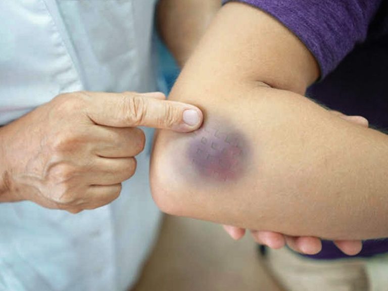 SB. BE CAREFUL, if you get these bruises on your body, here's what it ...